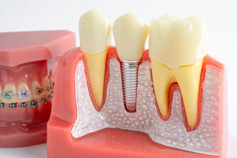 Transform Your Smile with a Front Tooth Implant: A Step-by-Step Dental ...